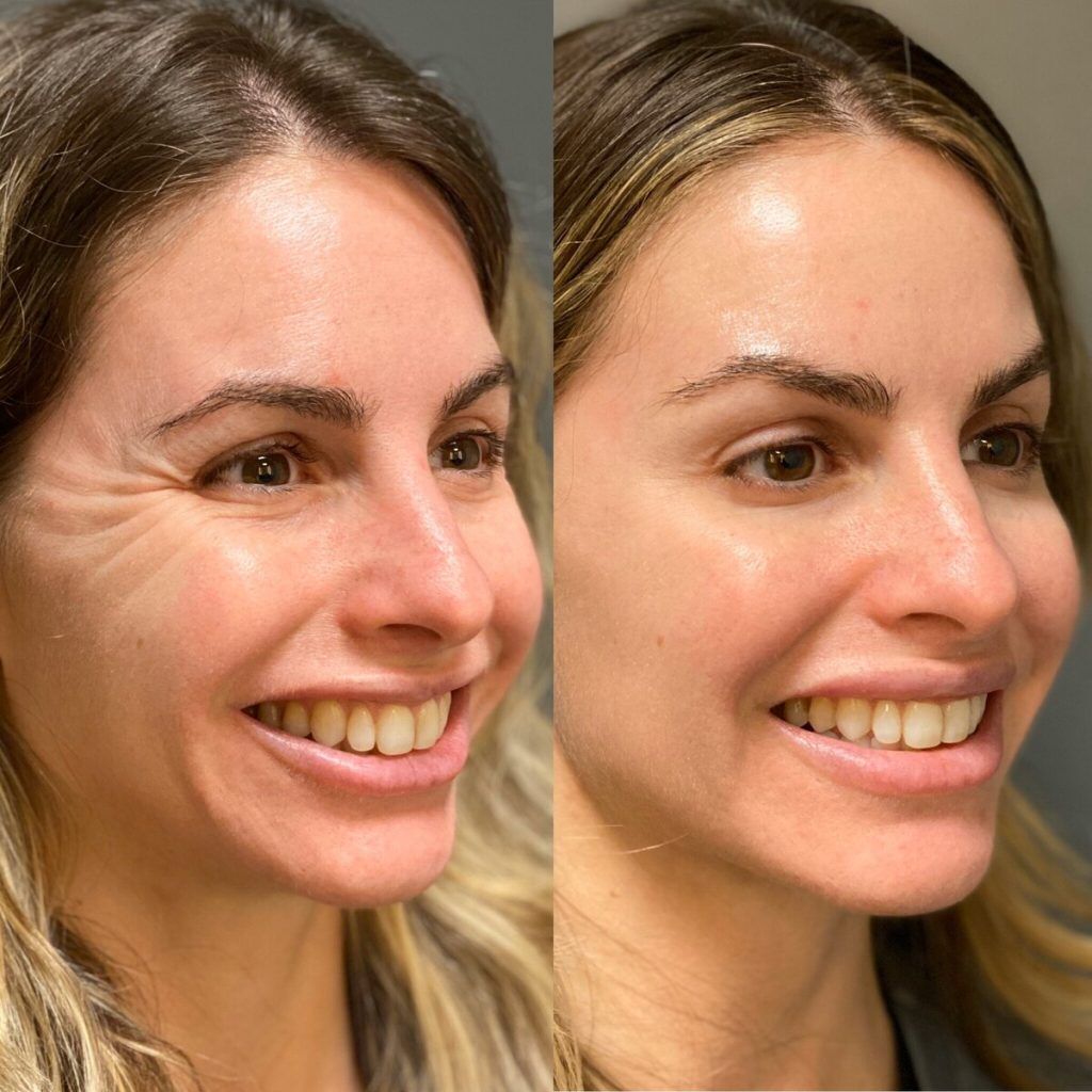 Botox Lip Flip Before And After What Is A Lip Flip And Who Needs It Ostomy Lifestyle